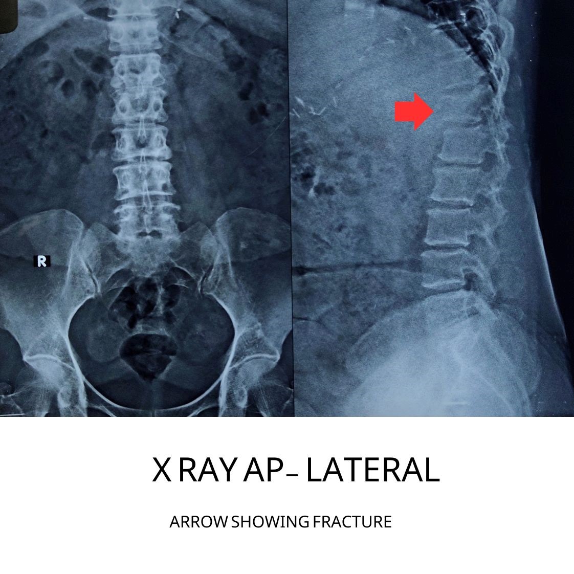 kyphoplasty By Dr Anshul Agarwal | Best Spine Specialist in Indore